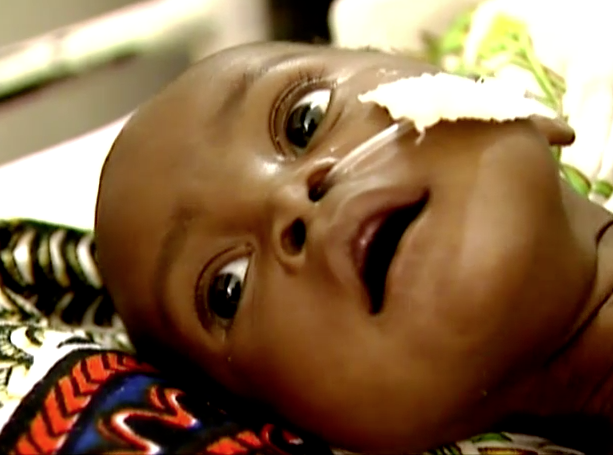 Kill or Cure - Deadly Pnuemococcal Disease - SWPictures